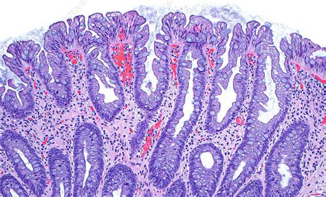 Hyperplastic Colon Polyp Light Micrograph Stock Image C061 4278 Science Photo Library
