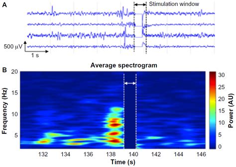 Critical Review Of The Responsive Neurostimulator System For Epilepsy Mder