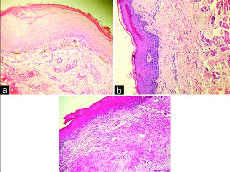 Photomicrographs Of Histological Sections Of A Early Osmf B