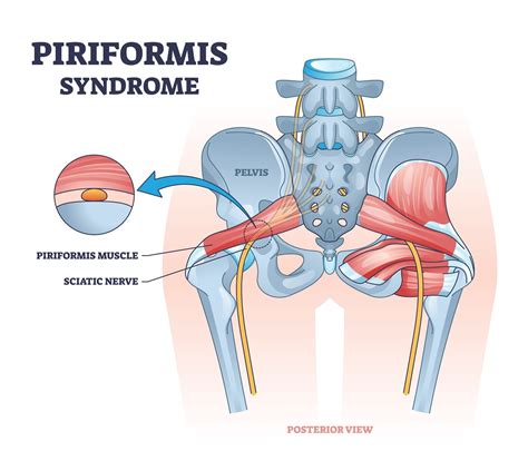 Piriformis Syndróm Príznaky Príčiny A Liečba Bolesti Sedacej Oblasti