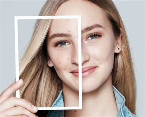 Teresa Caruso How To Make A Pimple Go Away