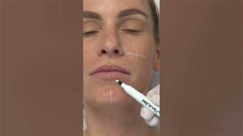 The Bap Technique Consists In Five Injection Points On Each Side Of The