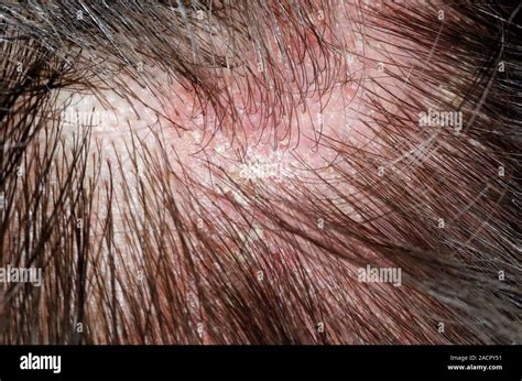 Red Flaky Patches Of Skin On The Scalp Of A 46 Year Old Male Patient With Psoriasis Psoriasis