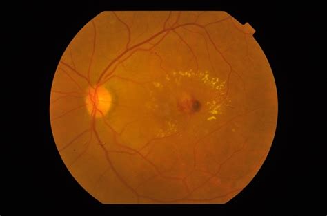 Retinal Artery Macroaneurysm Retina Image Bank
