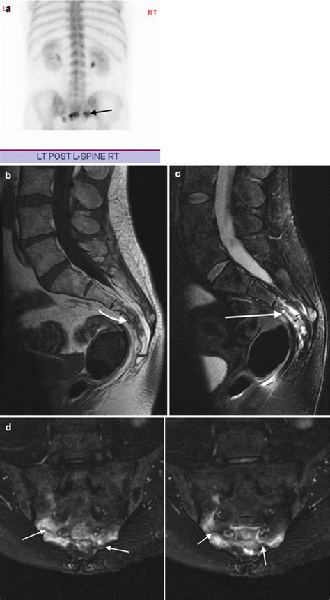 Sacral Biopsy Radiology Key