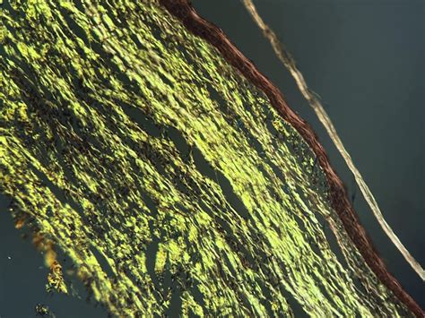 Amyloid Deposits In Skin W Brilliant Apple Green Birefringence On