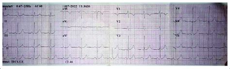 Electrocardiogram In Follow Up Assessment 10 Days After The Procedure Download Scientific