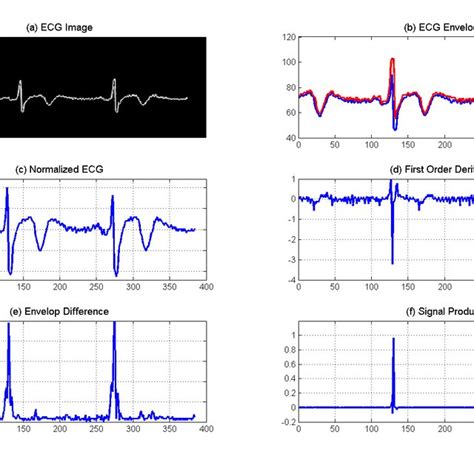 Illustration Of The Electrocardiogram A The Heart Cycle B A Normal