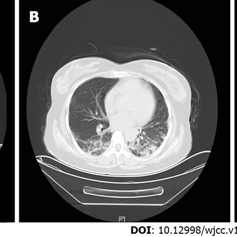 Chest Computed Tomography Scan A Diffuse Bilateral Ground Glass