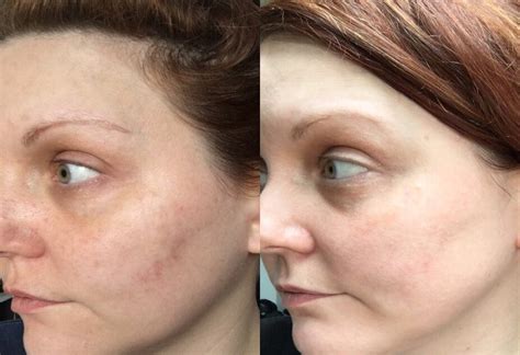 Ultimate Anti Aging Bundle Face Yoga