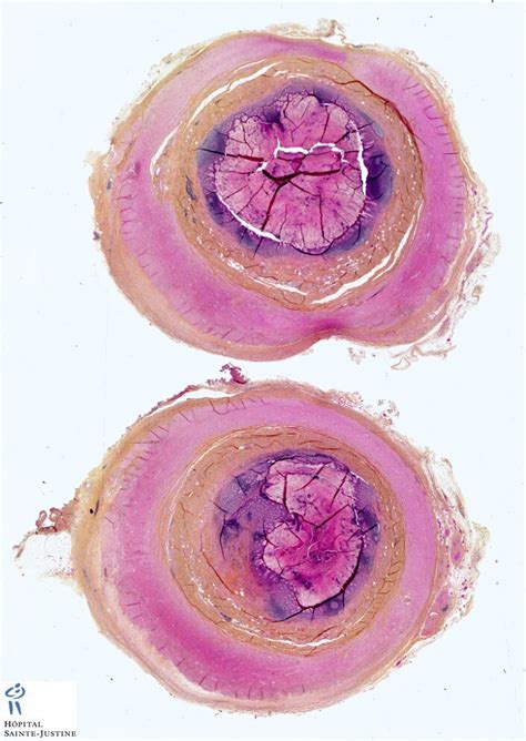 Appendiceal Cystic Fibrosis Human Pathology
