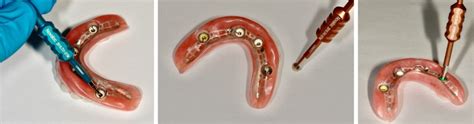 Novaloc A First Choice System For Overdentures Spear Education
