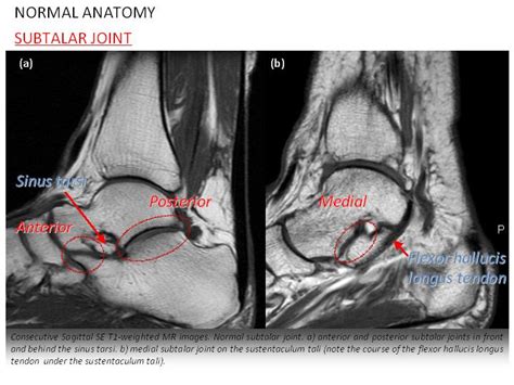 Ct Anatomy Of Subtalar Joint At Janine Moore Blog
