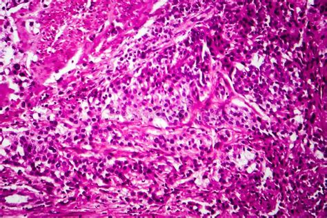 Bladder Cancer Light Micrograph Stock Image Image Of Morphological