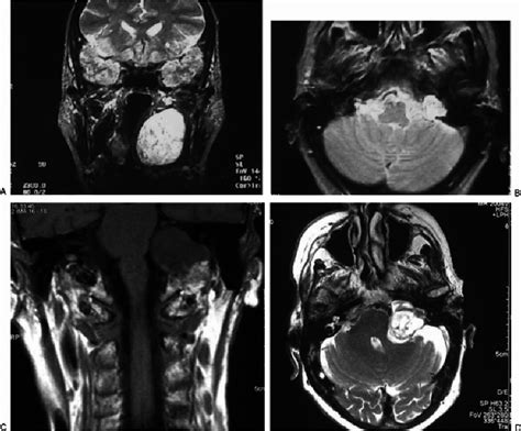 Preoperative T2 Weighted Magnetic Resonance Imaging Mri Scans