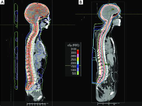 Dosimetry Of A Patient Treated With Photon Csi With Volumetric