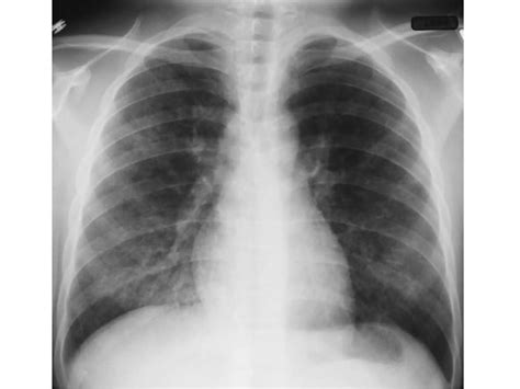 Pneumonia Classification And Etiology Ppt