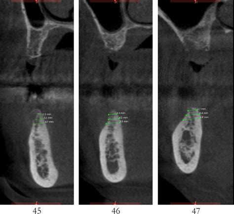 Residual Bone Crest 45 46 47 Download Scientific Diagram