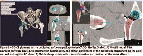 3d Ct A Better Map For Hip Surgery Medicad