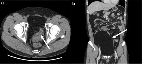 Contrast Enhanced Abdomen Pelvis Computed Tomography Scans A Axial