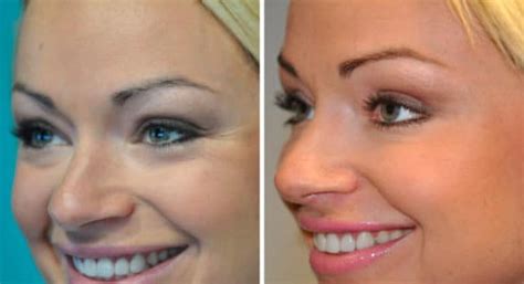 Botox Treatment In Virginia Washington D C And Maryland