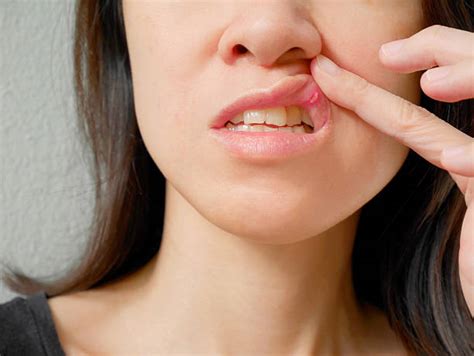 Fungal Infection On Lips Its Causes And How To Treat It Ph