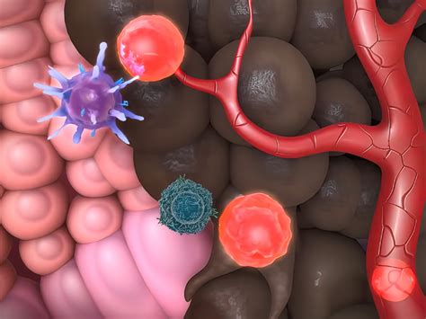 What You Need To Know About The Use Of Neoadjuvant Cemiplimab In
