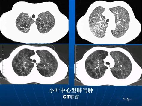 肺气肿ct片图片图解 千图网