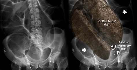 Learningradiology Cecal Volvulus Cecum Volvulous