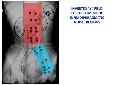 Radiation Therapy For Early Stage Hodgkins Lymphoma