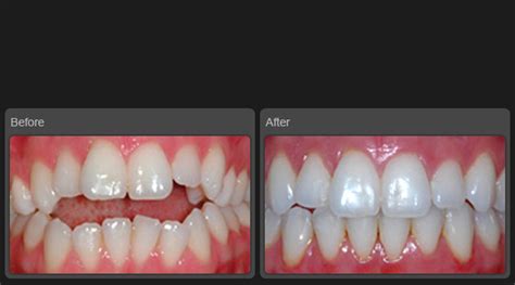 Orthodontia Braces Treatment Ahmedabad Gujarat India Crooked Malalignment Teeth Dental Clinic