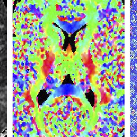 Different Methods For Visualizing Diffusion Tensor Information Left