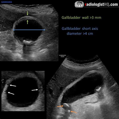 Emphysematous Cholecystitis Ultrasound