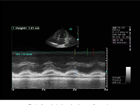 Figure 1 From Assessment Of Left Ventricular Long Axis Contraction In Patients With Ischemic