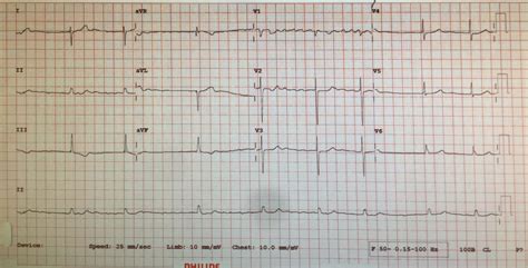 Ecg 7 September 2022 Emergucate