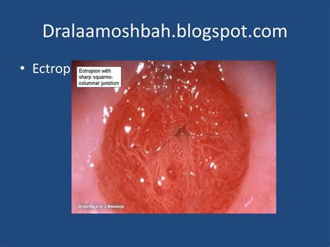 Ppt Common Issues In Gynecology Hpv Testing Bioidentical Hormones Common Cervical Lesions