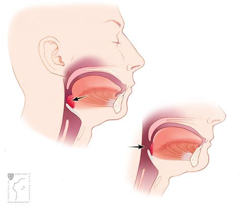 Lingual Tonsil Model