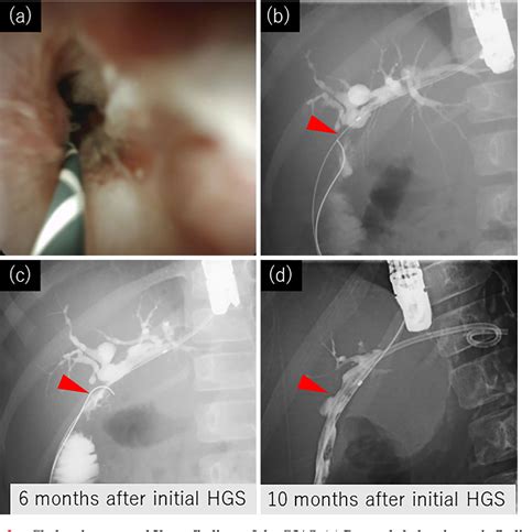 Figure 1 From Endoscopic Ultrasound Guided Hepaticogastrostomy In A Seven Year Old Girl