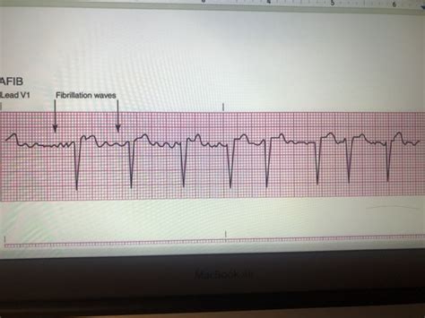 cardiac rhythms flashcards quizlet