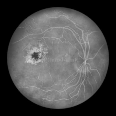 Macular Edema Stock Illustrations 43 Macular Edema Stock Illustrations Vectors And Clipart