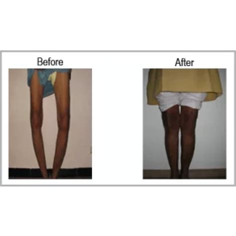 Best Knee Surgeries Surgeon Ahmedabad Dr Samir Nanavati