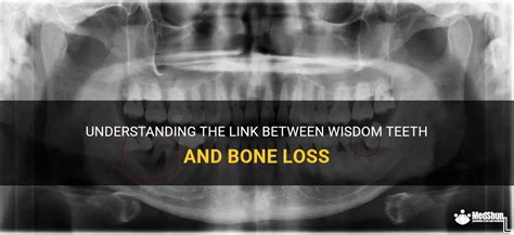 Understanding The Link Between Wisdom Teeth And Bone Loss Medshun