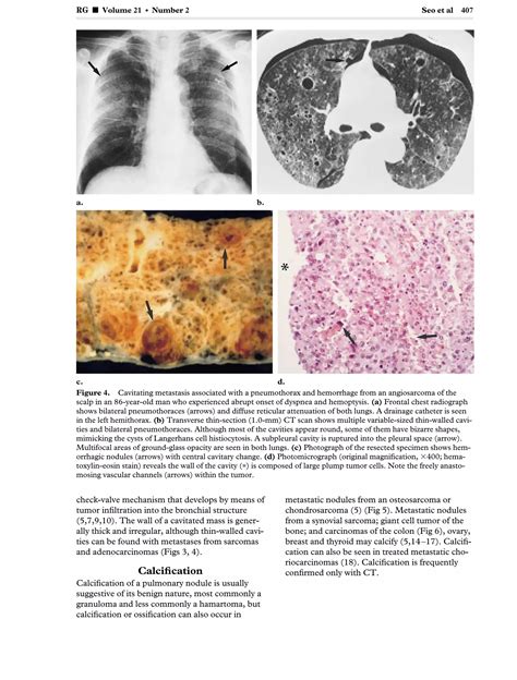 Atypical Pulmonary Metastases Pdf