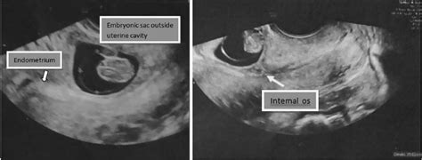 Figure 2 From Methotrexate Treatment Of Very High β Hcg Ectopic Pregnancy On Previous Cesarean