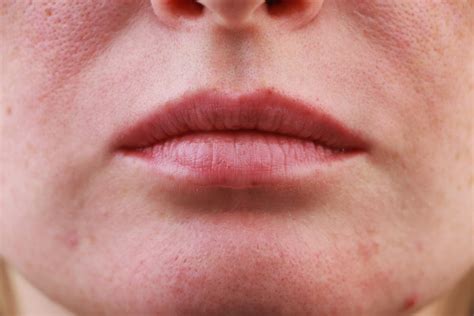 Red Sore Rash Around Lipstick Lipstutorial Org