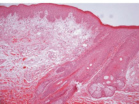 Pruritic Diffuse Erythematous To Brown Colored Papuloplaques With Download Scientific Diagram