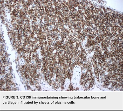 3 She Was Evaluated By A Radiation Oncologist For Localized