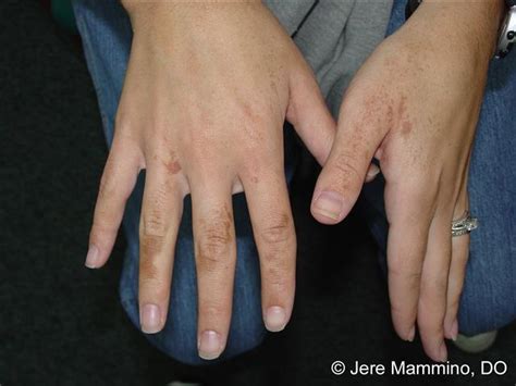 Phytophotodermatitis American Osteopathic College Of Dermatology Aocd Phytophotodermatitis American Osteopathic College Of Dermatology Aocd