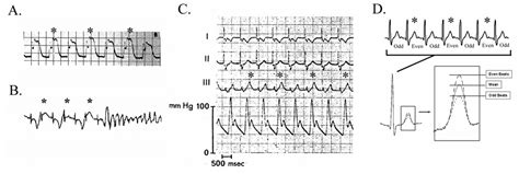 T Wave Alternans Testing For Ventricular Arrhythmias Pmc