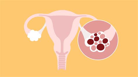 Pcos Polycystic Ovary Syndrome Macie Medical
